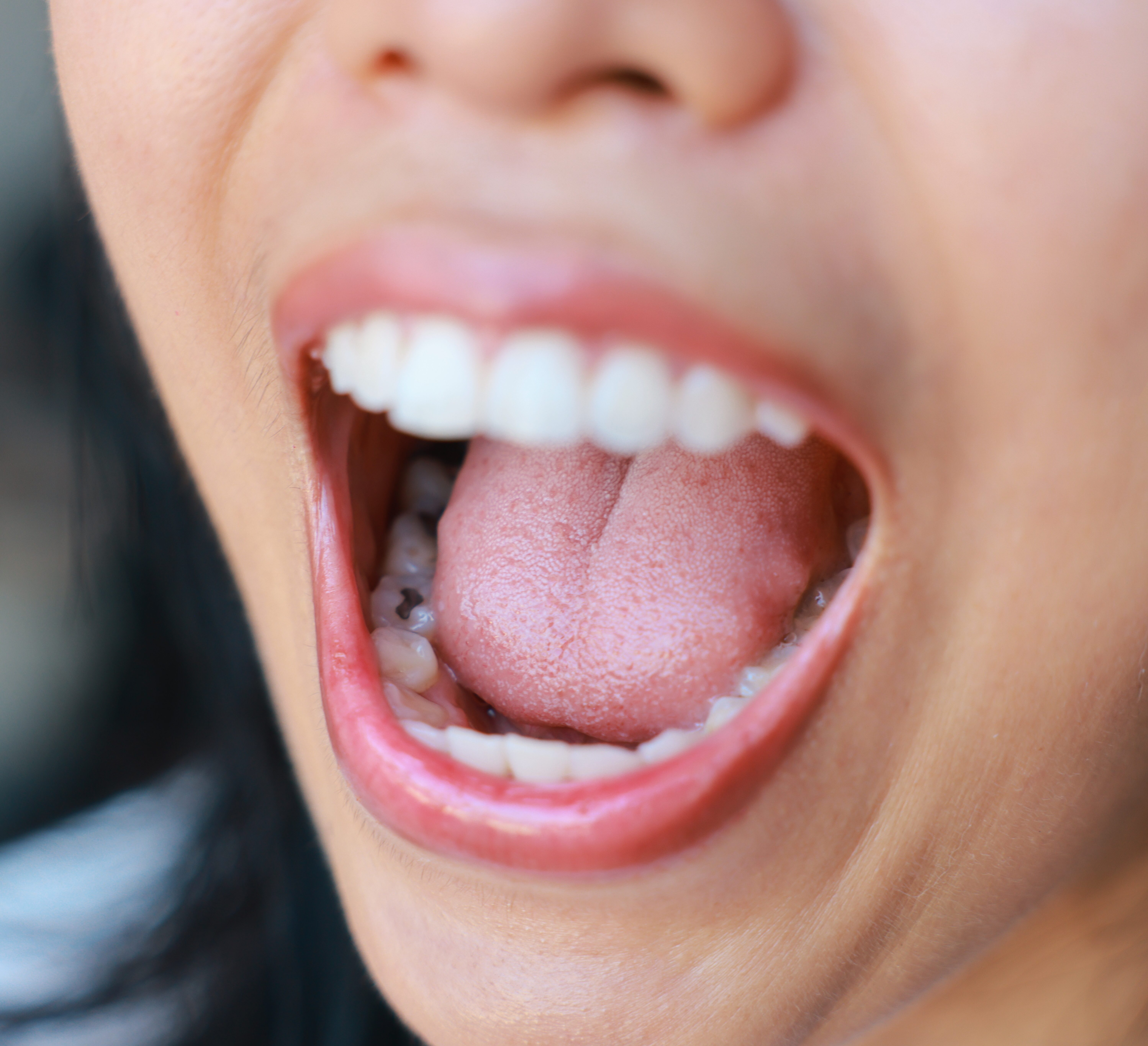 Tooth Fillings Brisbane | Fix Dental